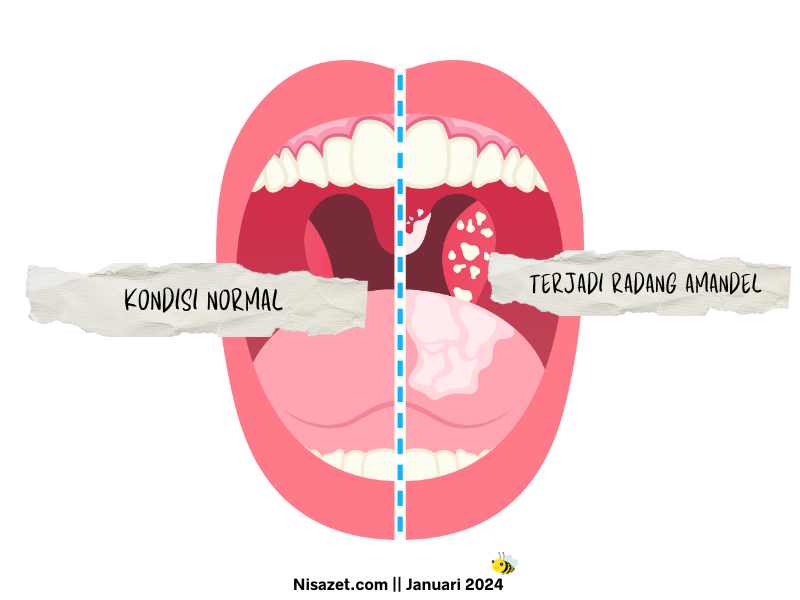 √Pengalaman Operasi Amandel Dengan Bpjs Di RS Doris Sylvanus