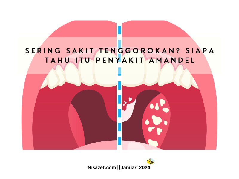 √Sering sakit tenggorokan? Siapa tahu itu Penyakit Amandel - www ...